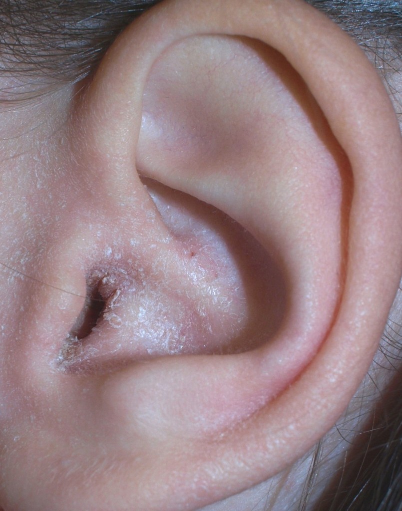 How To De-Water Your Ear Canal