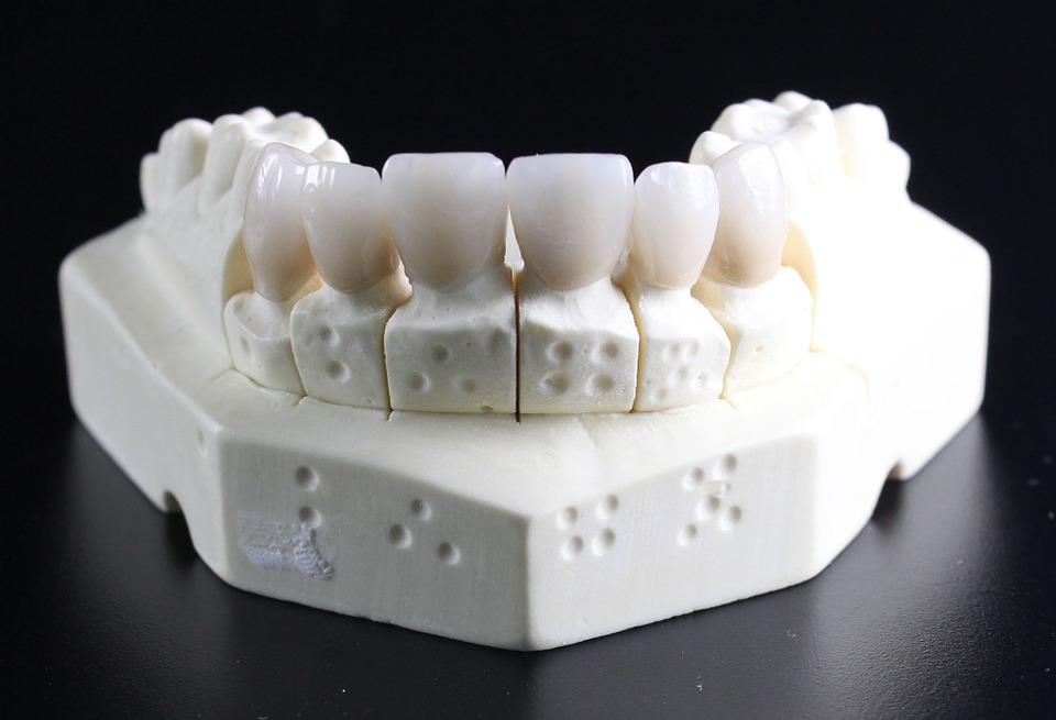 A Dental Inlays Guide Including Type And Benefits