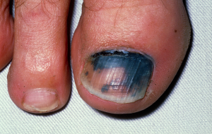 Causes Of Horizontal Ridges On Toenails And Surefire Remedies