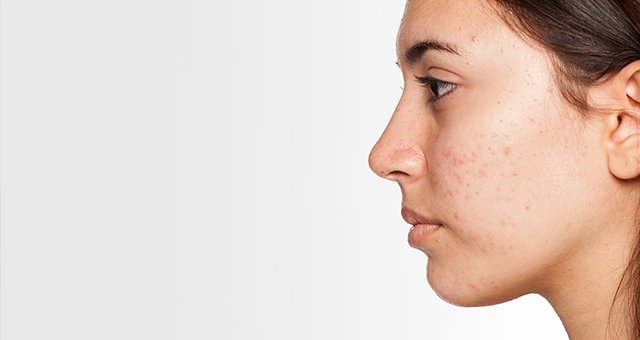 Essential Information You Should Know About Skin Purging